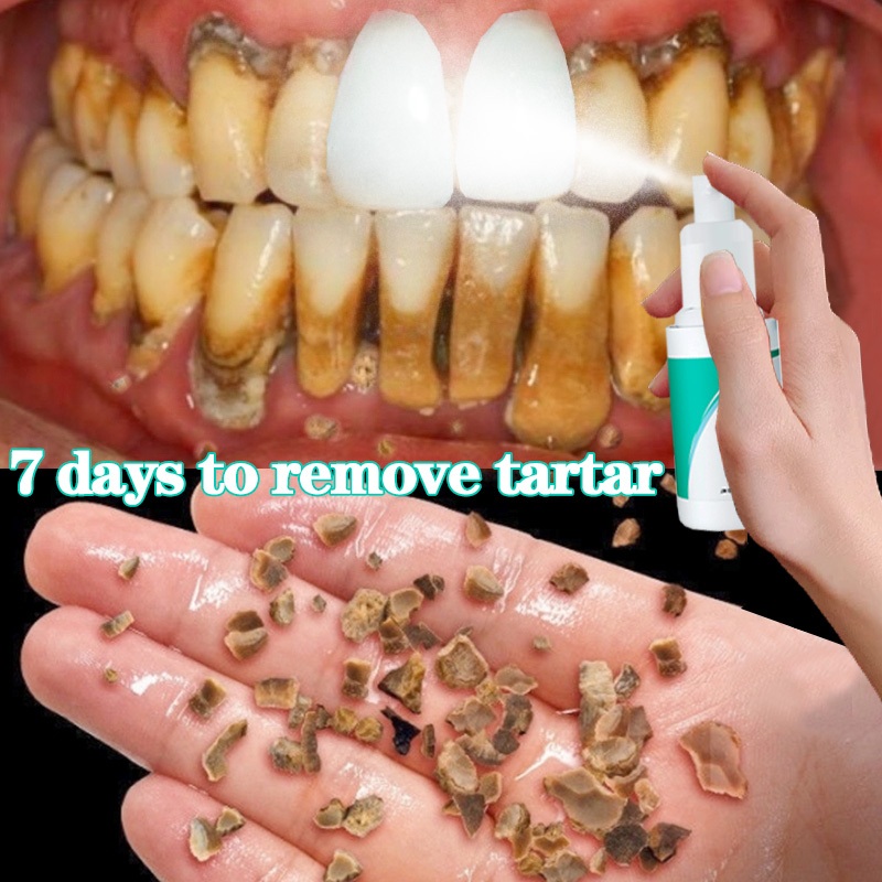 Tartar removal for teeth Teeth Whitening Tartar remover for teeth 30ml ...