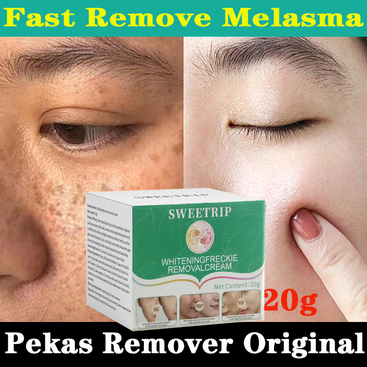 SWEETRIP Effective Melasma Cream Pekas Remover Whitening Skin Facial ...