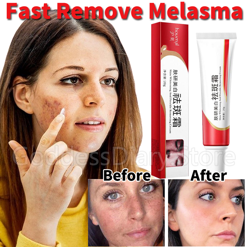 Melasma Cream Pekas Remover Original Collagen Pekas & Freckles Remover ...