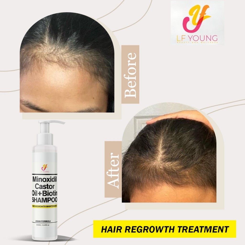 Minoxidil 20% Hair Grower Shampoo Original LF Young for Hair Loss ...