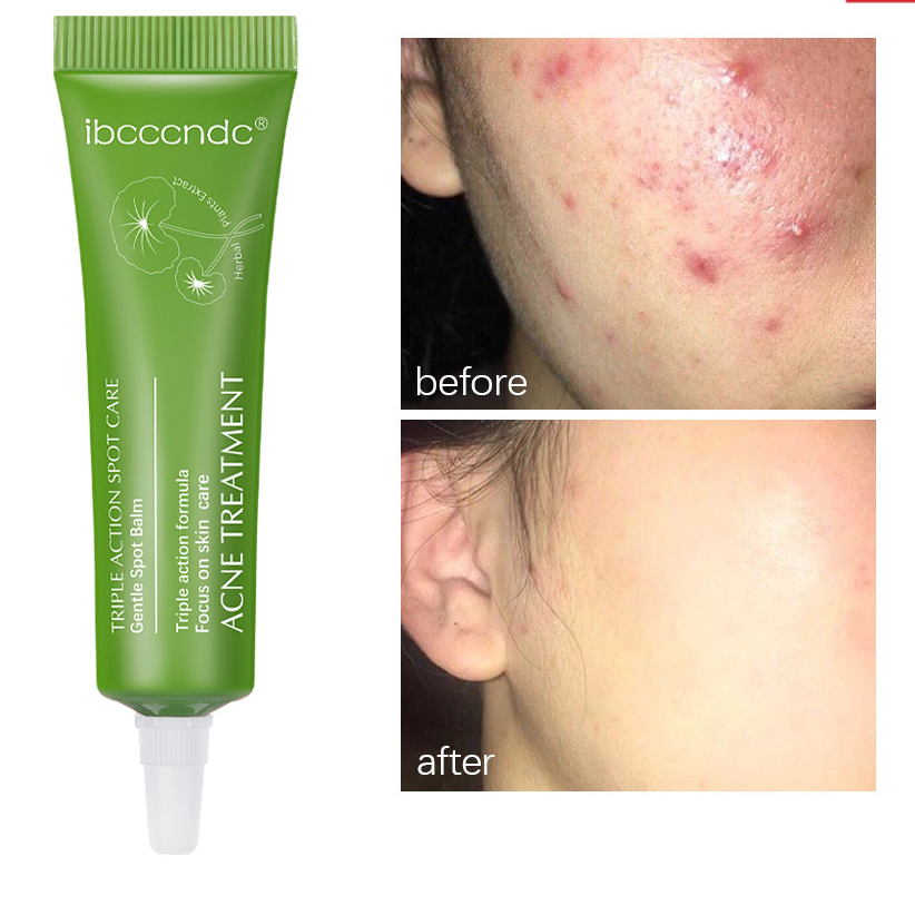 Ibcccndc Acne Remover Cream Effectively Control Sebum Secretion Acne ...