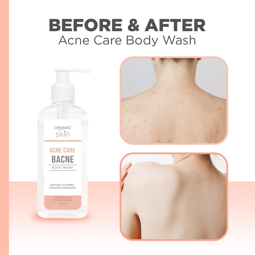 Organic Skin Japan Acne Care 3 Steps Set Bacne Body Wash 250ml Lotion 250ml Zit Away Spray 100ml Shopee Philippines