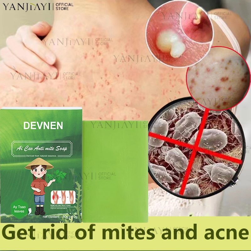 DEVNEN Wormwood Mite Removal Soap Anti Itching Anti Fungus Acne ...