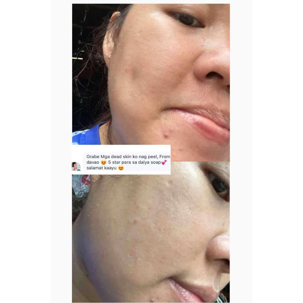 Dalya Whitening Peel Soap by Niel Padilla w/ NIACINAMIDE, VITAMIN C ...