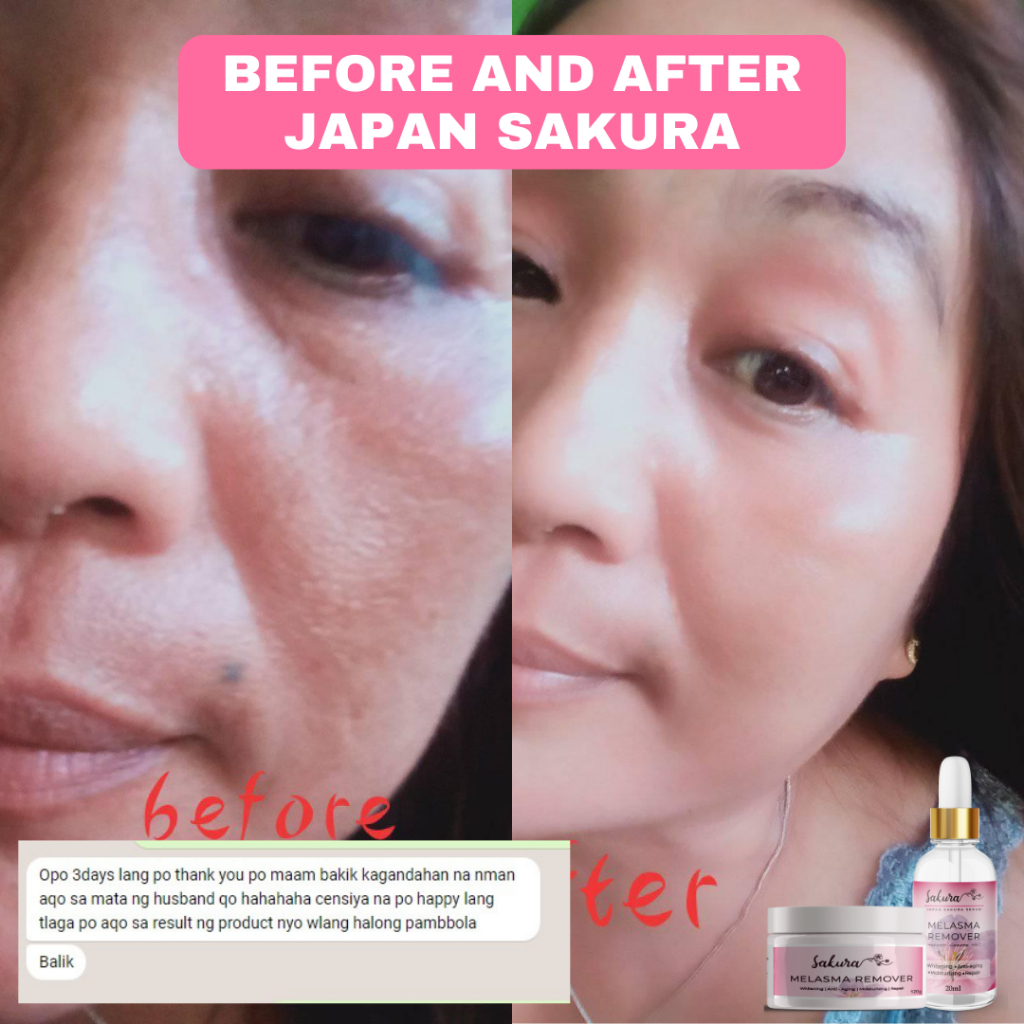 TANGGAL PEKAS Sakura Melasma Remover Cream Serum Soap Toner Sunblock ...