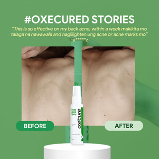 OXECURE 2% Salicylic Acid Body Acne Spray 50ml | Shopee Philippines