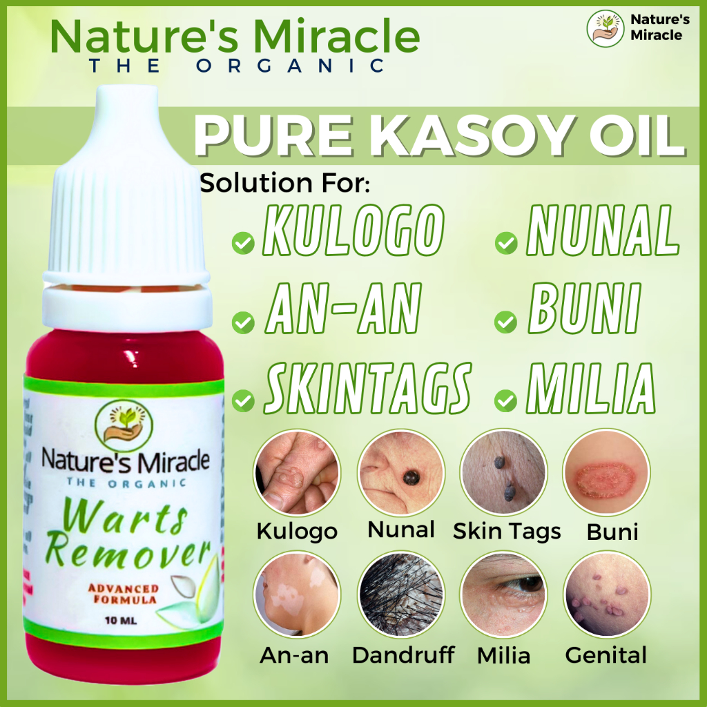 Warts remover original kasoy oil kasoy oil wart removal original kulugo ...