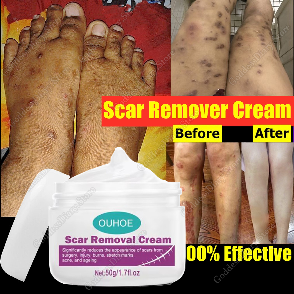 Scar Removal Cream Old Scar Remover Cream Effective Peklat Acne ...