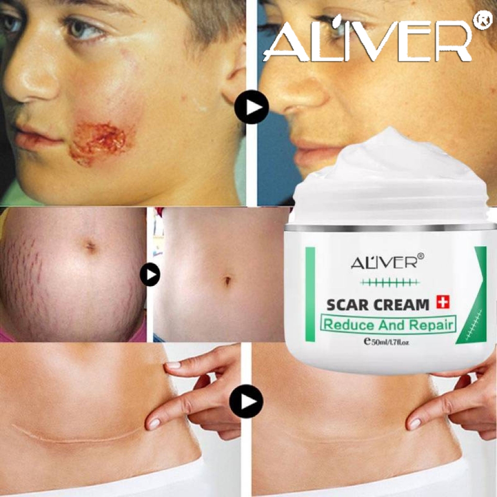 Aliver Scar Cream Repair Stretch Marks Acne Marks Acne Scars Full Body ...