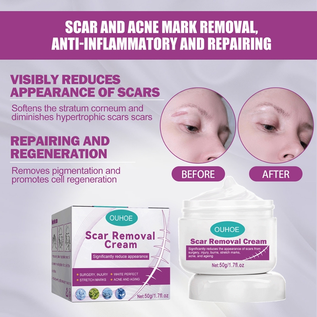 Scar Removal Cream Old Scar Remover Cream Effective Peklat Acne ...