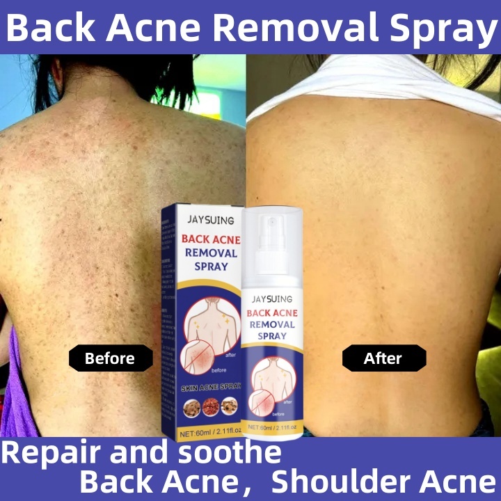 Body Anti Acne Spray Back Acne Treatment Reduce Back Acne Close Pores ...
