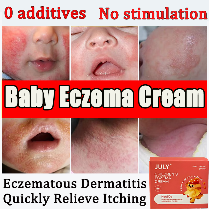 Eczema Cream For Baby Quick Relief Of Itching Antibacterial Anti Rashes ...