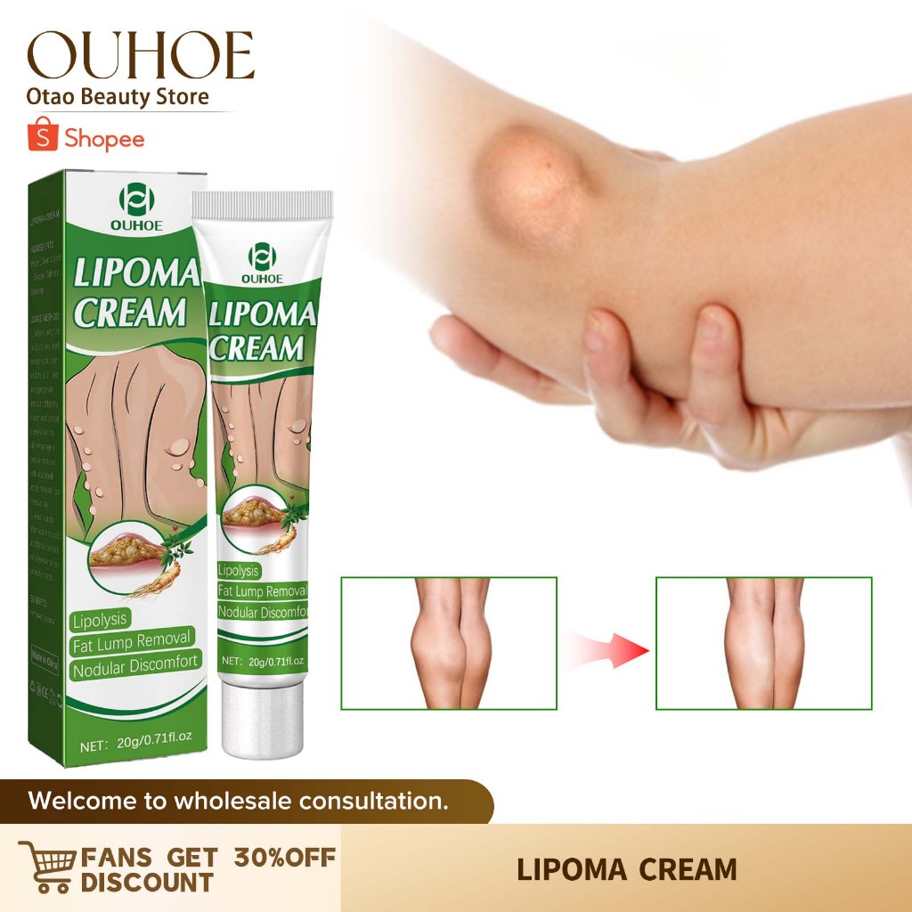 OUHOE Lipoma Removal Cream 20g Improve Skin Swelling Subcutaneous Lump ...