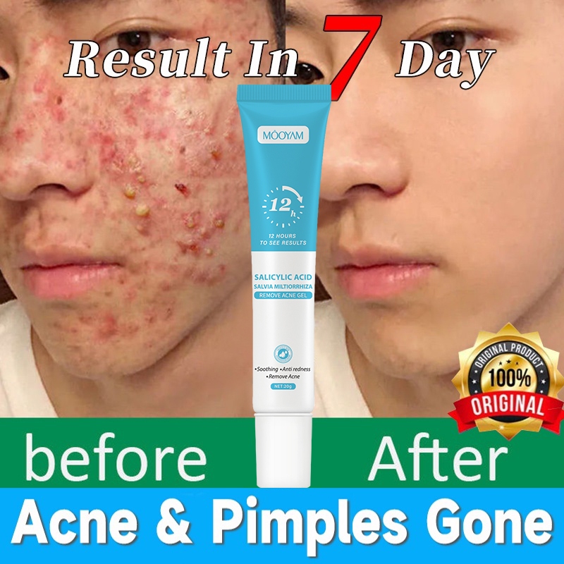 Salicylic Acid Acne Treatment Gel Oil Control Acne Scar Treatment ...