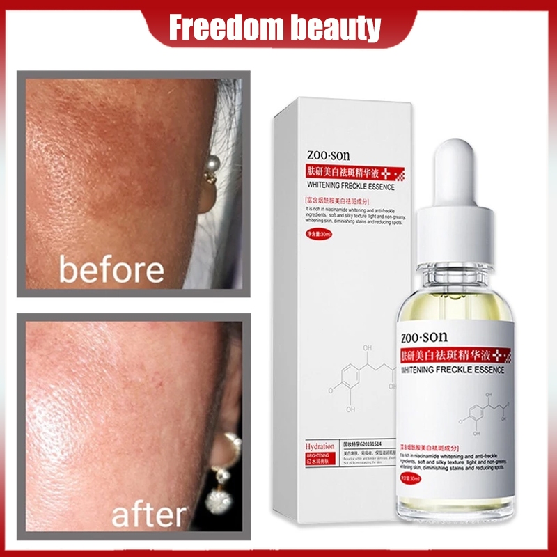 30ml Pekas Remover Serum For Melasma And Dark spot Melasma Serum Pekas ...