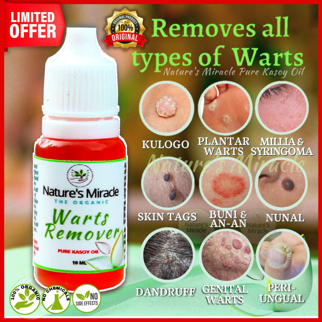 warts remover original kasoy oil warts remover skincare organic warts removal nature s miracle ...