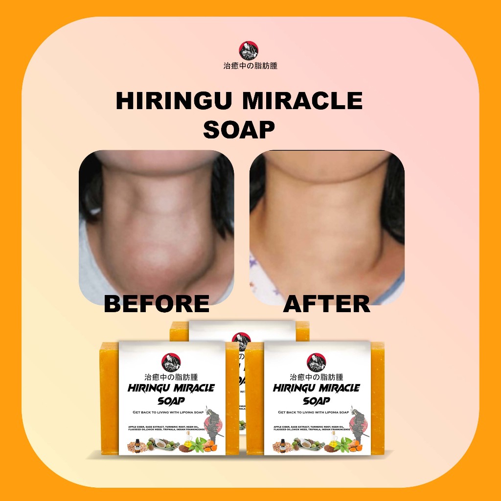 Hirungu Lipoma Soap Original Lipoma Removal Soap Sabon Gamot para sa ...
