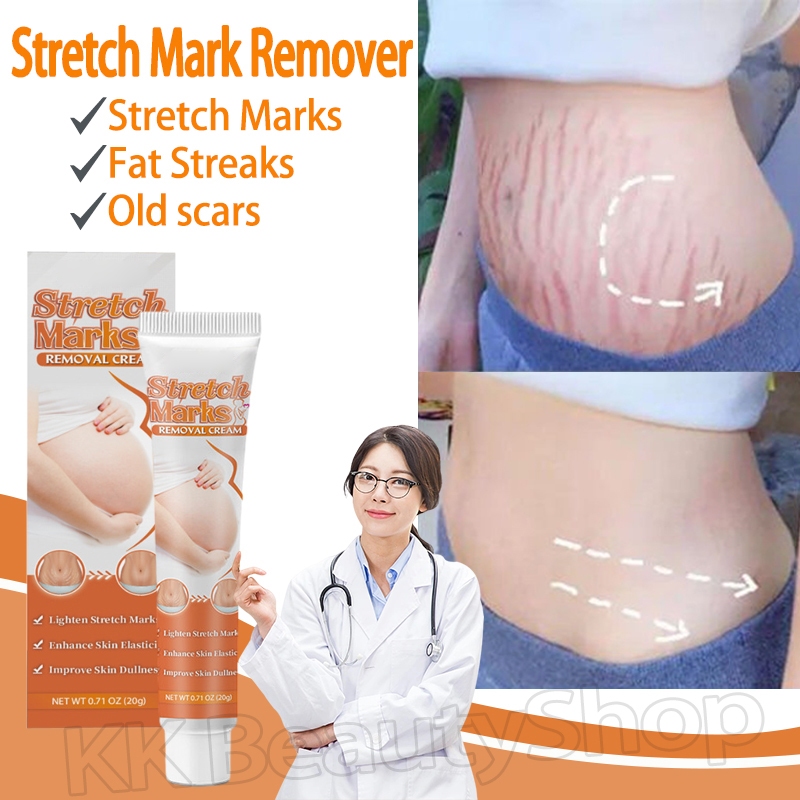 Stretch Mark Remover Scar Remover Cream For Pregnant Lighten Stretch ...