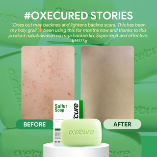 OXECURE Sulfur Soap 30g | Shopee Philippines