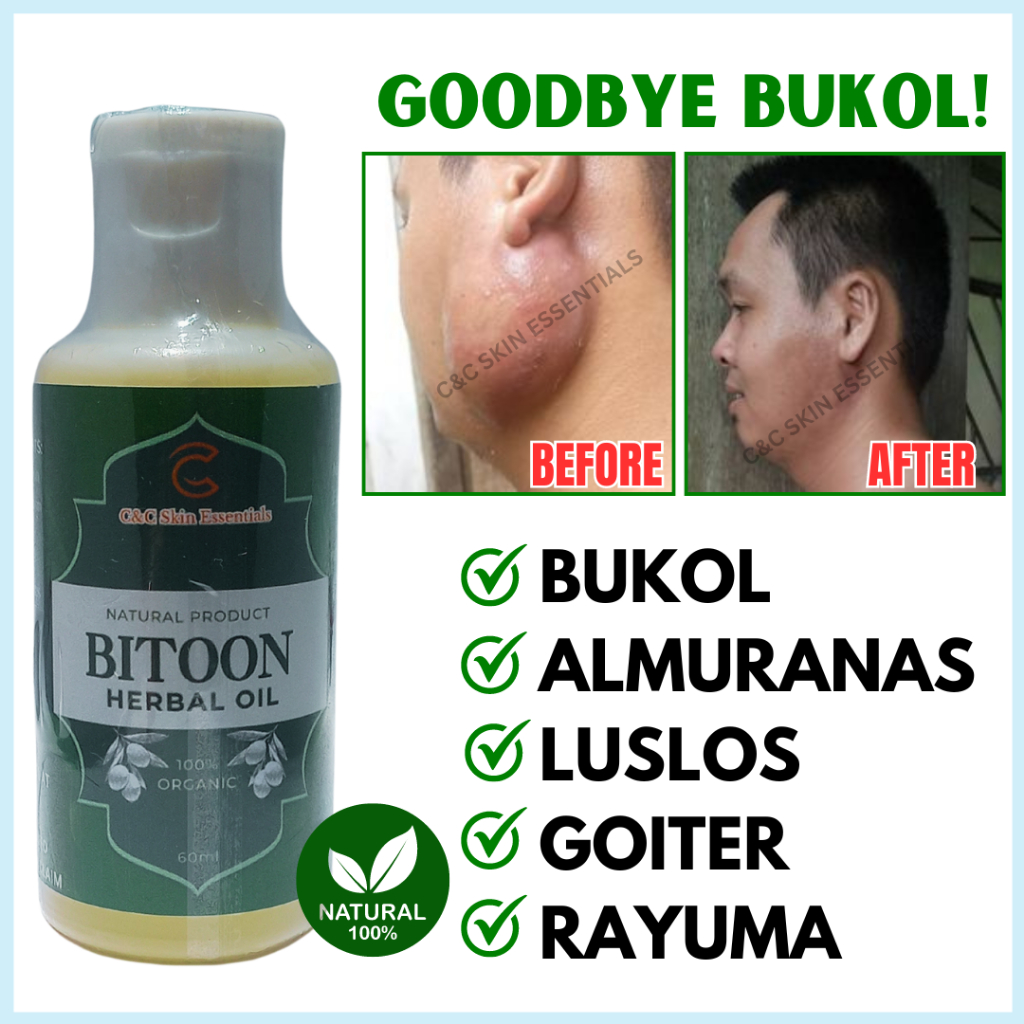 Original Bitoon Herbal Oil 60ML: Effective Gamot sa BUKOL, CYSTS, TUMOR ...