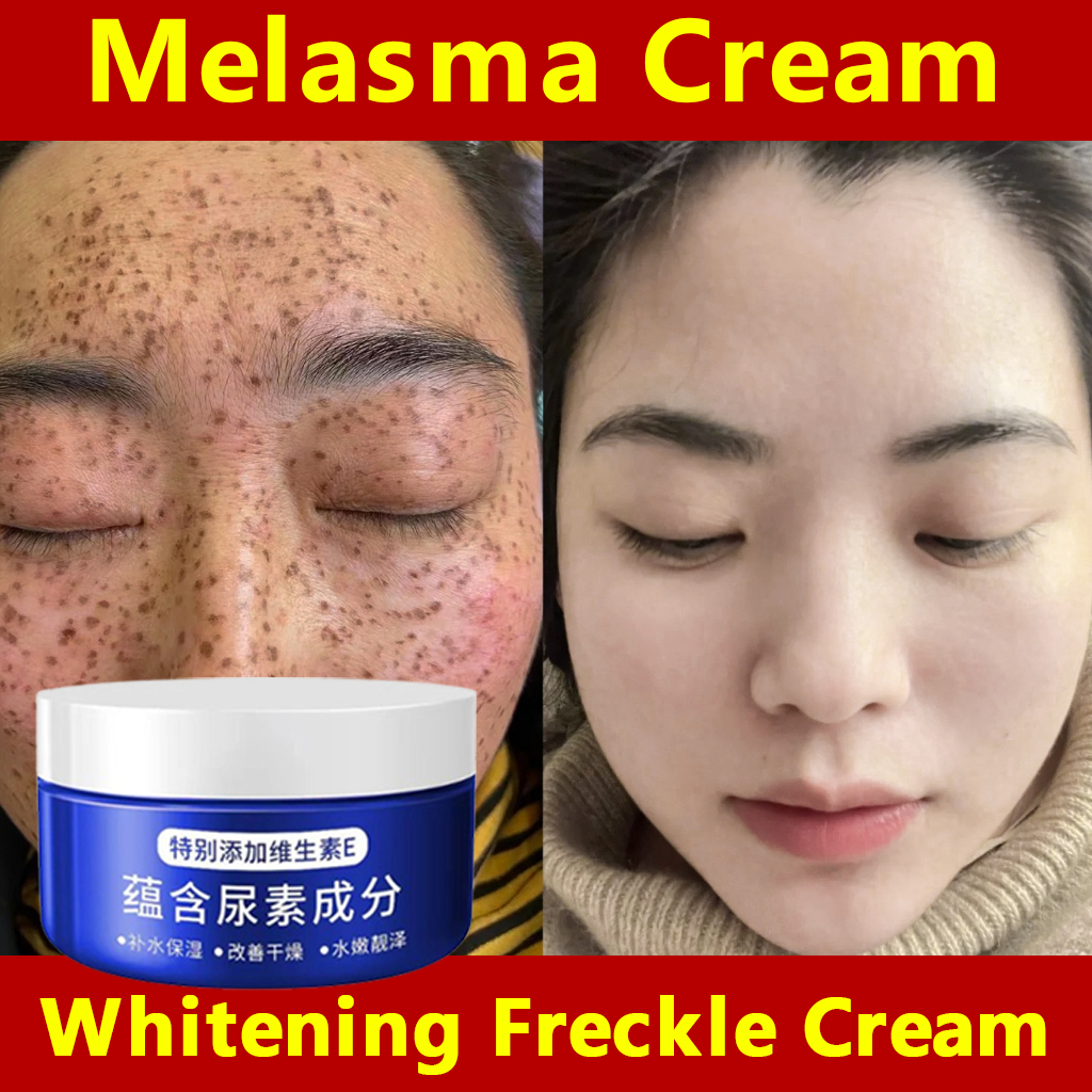 Whitening Freckle Cream Melasma Cream Dark Spot Remover Moisturizer ...