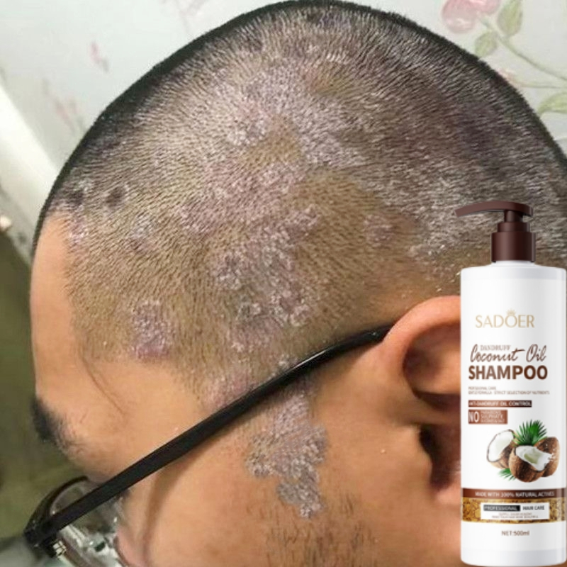 Psoriasis shampoo Coconut oil anti dandruff shampoo itchy scalp ...