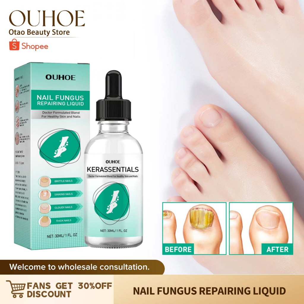 Ouhoe Anti Fungal Nail Treatment Liquid Anti-Infection Onychomycosis ...