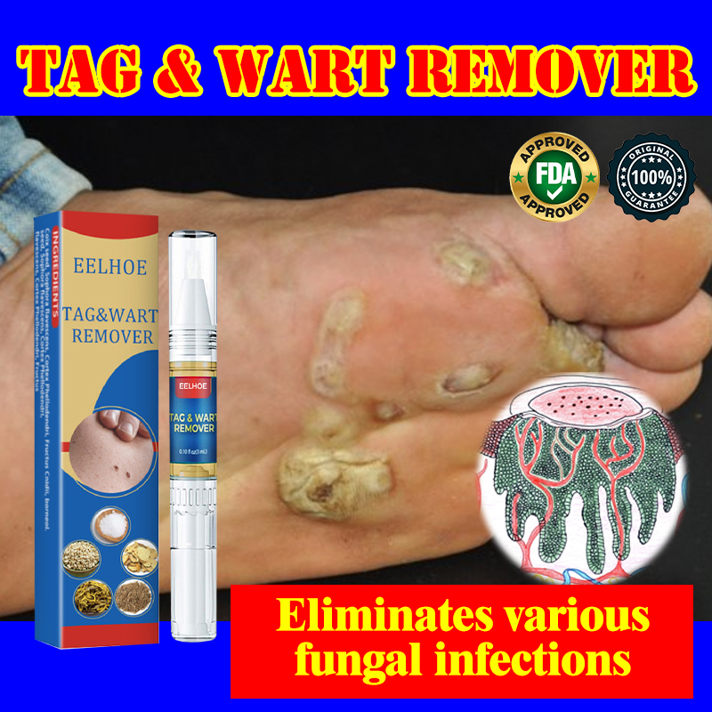 Wartz Warts Remover Original Cream Warts Removal Pen kasoy Cream Wart ...