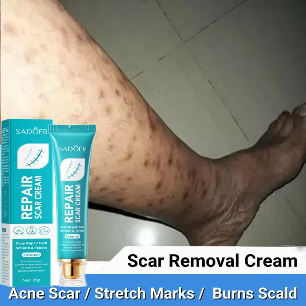 Scar Removal Cream For Face Arms Legs Repair Old Scar Acne Stretch ...