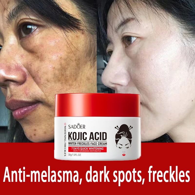 Melasma Cream Kojic Acid Whitening Face Cream Anti Freckle Pekas ...
