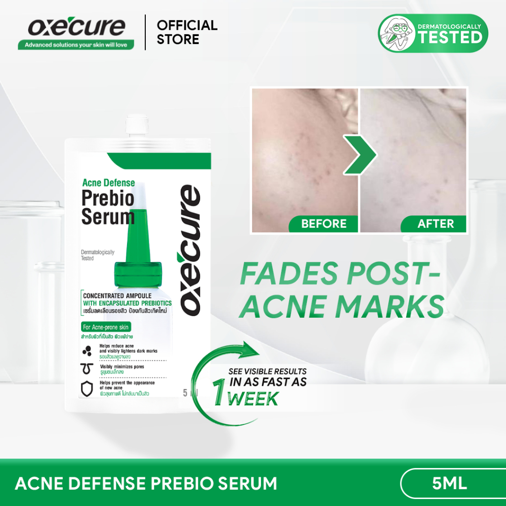 OXECURE Acne Care Starter Kit (Cleanser, Serum, Moisturizer, Powder Mud ...