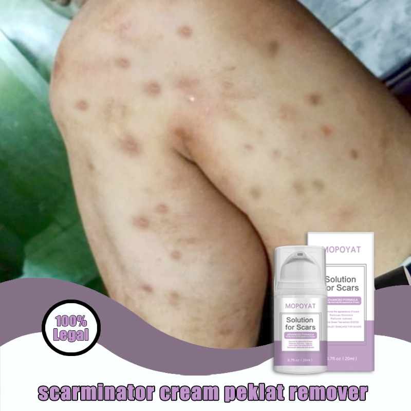 Peklat Remover cream scar remover cream peklat remover scarminator ...
