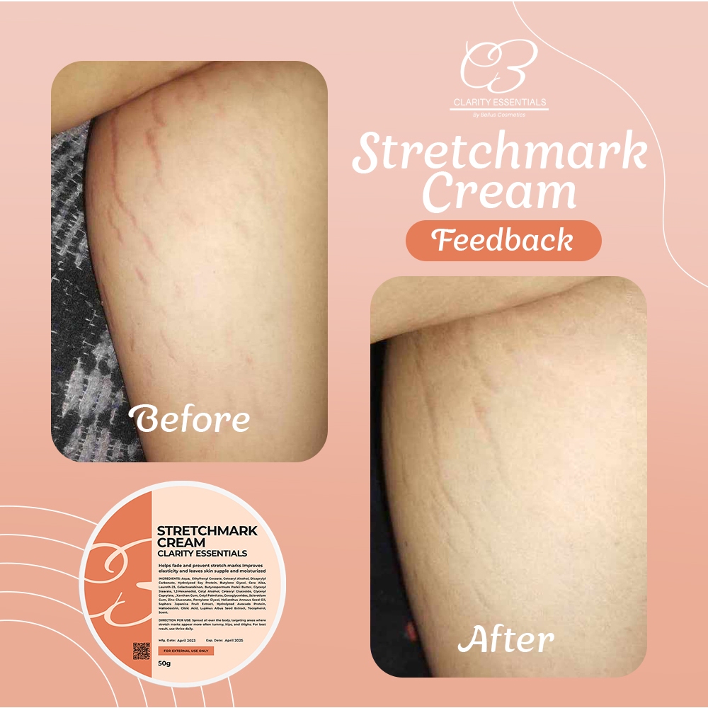Stretch Mark Remover Cream - Clarity Essentials | Shopee Philippines