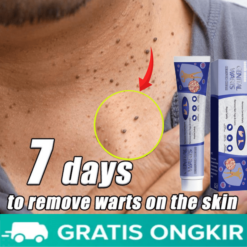 Warts Remover Original Cream Warts Magic Remover Wart Ointment Original ...