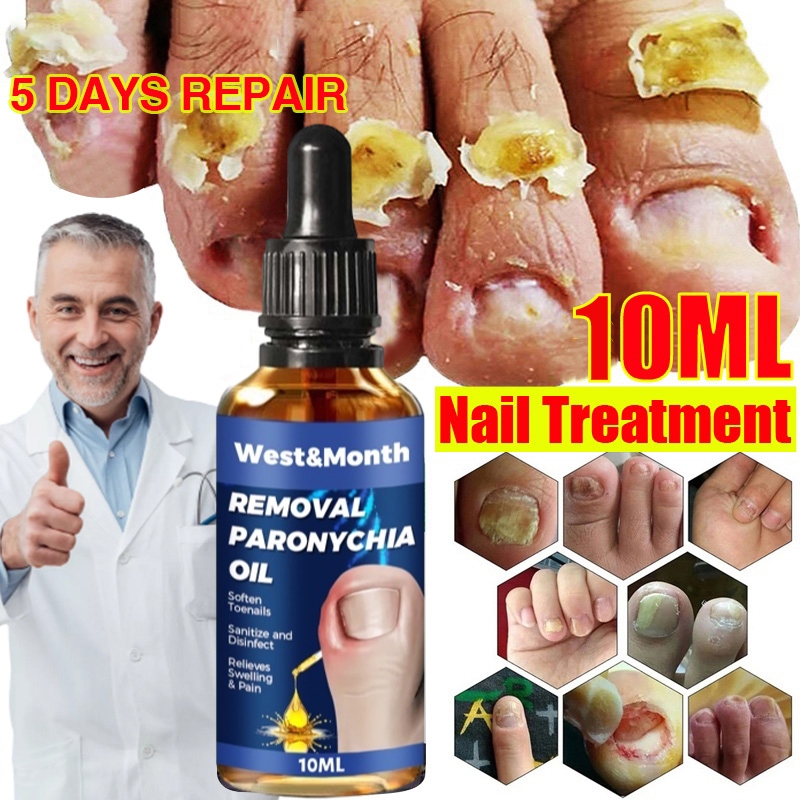Anti Paronychia Relief Oil Nail Fungus Treatment Remove Onychomycosis ...