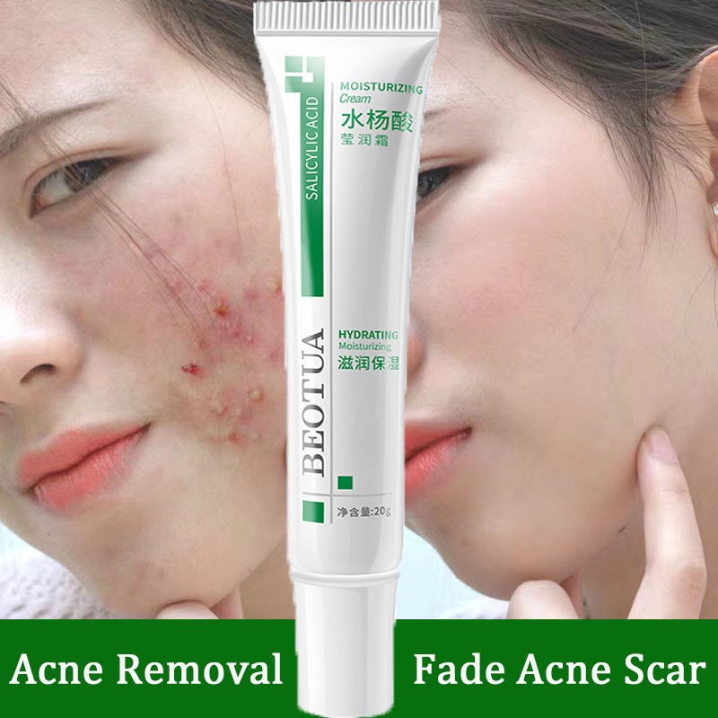 Salicylic Acid Acne Treatment Gel Ointment Pimple Remover Redness Skin ...