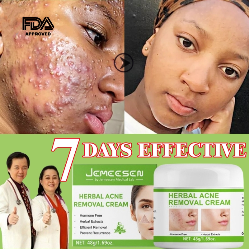 Herbal Acne Remover Cream Effective Acne Treatment Pimple Eraser Spot ...