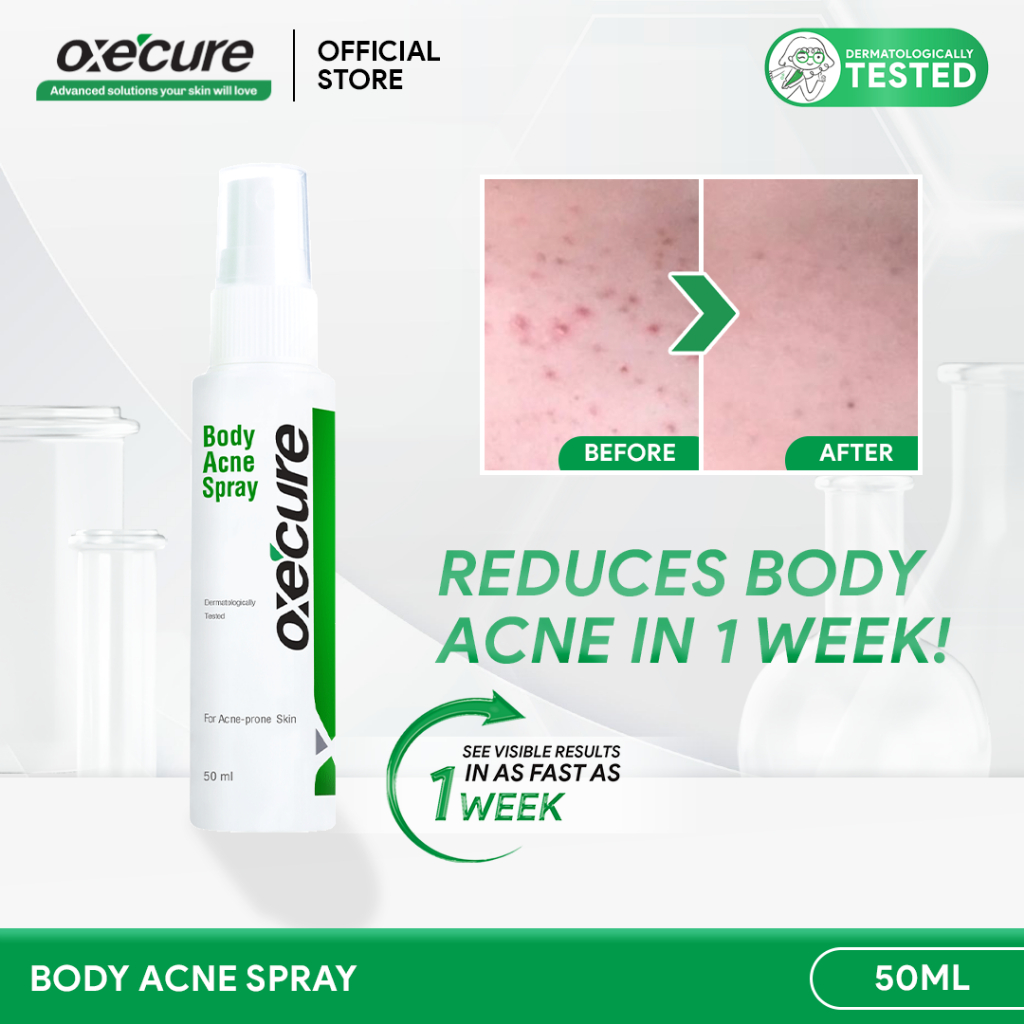 OXECURE 2% Salicylic Acid Body Acne Spray 50ml | Shopee Philippines