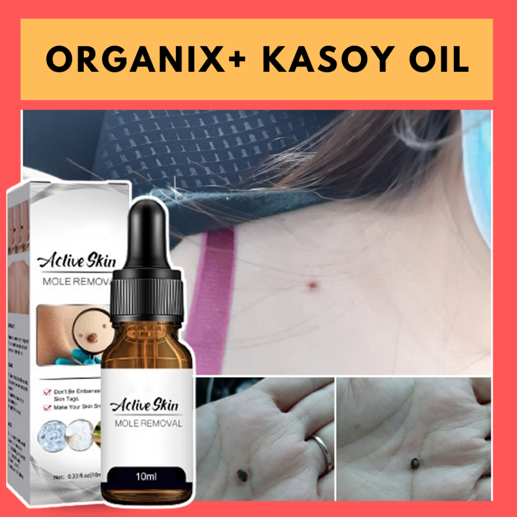 Warts Remover Kasoy Oil Kulugo Skin Tags Mole Remover Effective ...