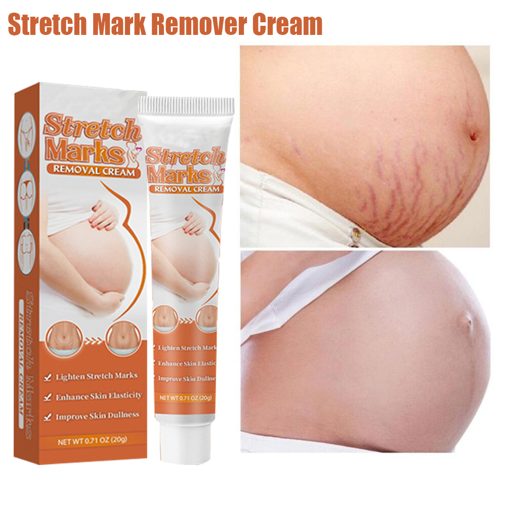 Stretch Marks Remover Cream Peklat Remover Scar Repairing Ointment Scar