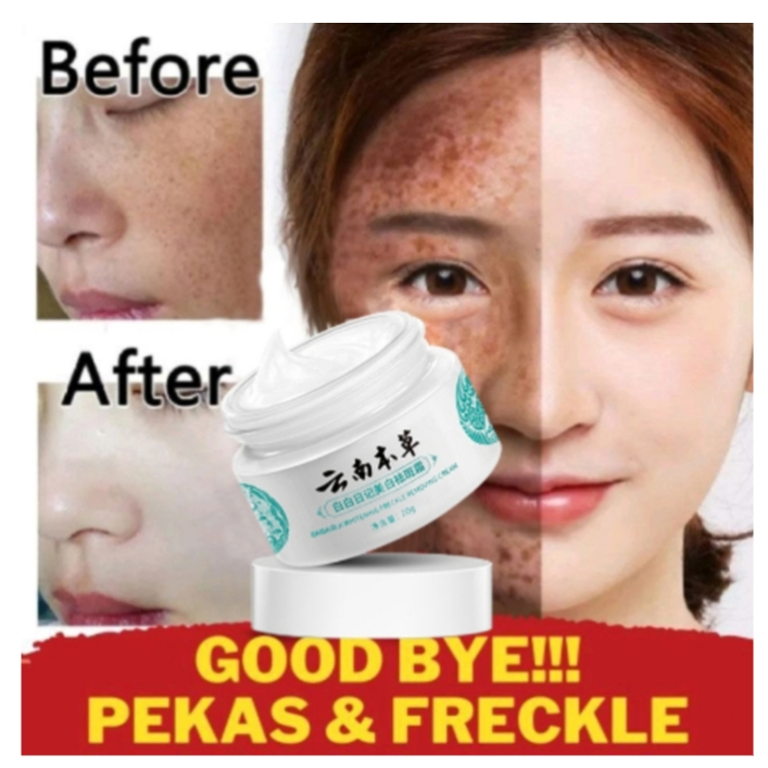 JAPANESE Melasma Cream Original For Fac Pekas & Freckles Remover 30g ...