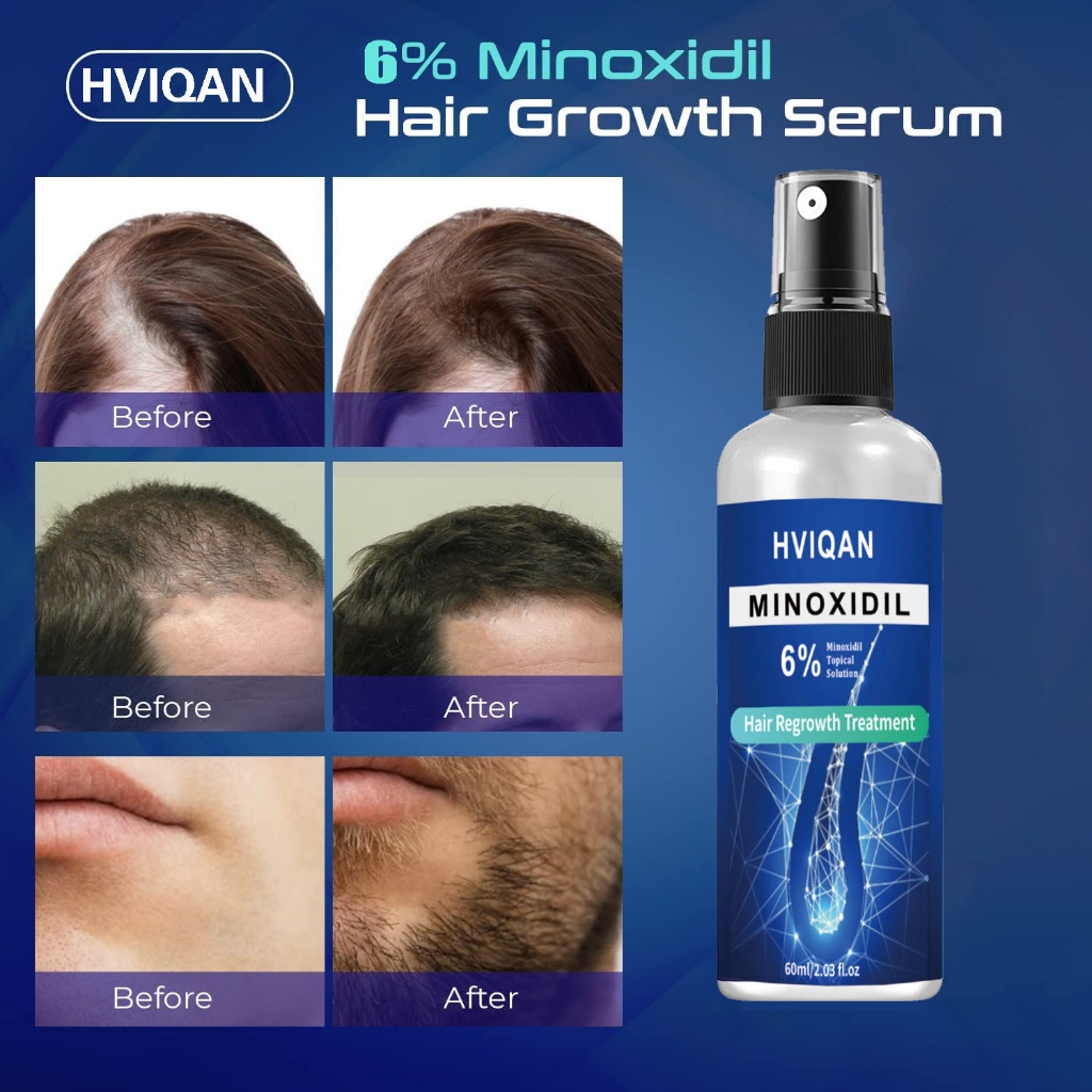 Minoxidil 6% Hair Growth Serum Fast Hair Growth Minoxidil Hair Grower ...