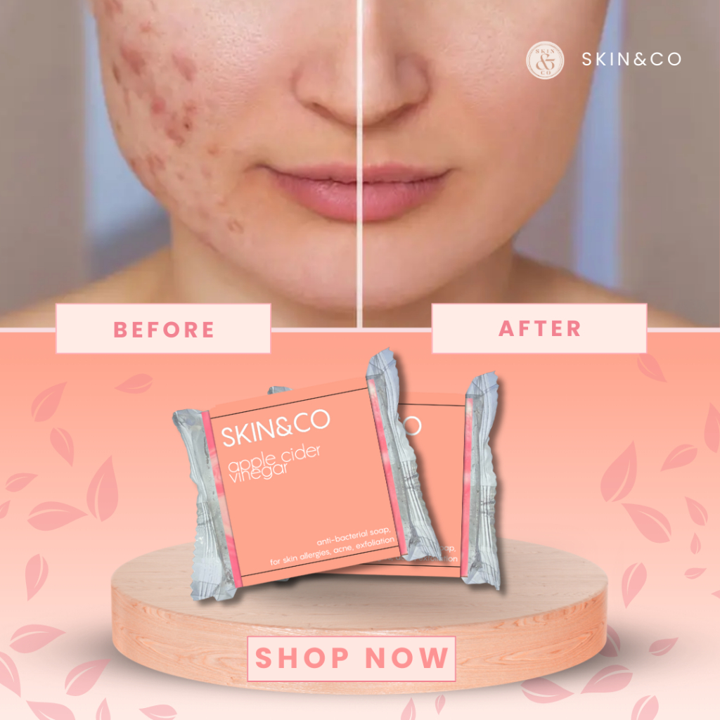 Skin & Co Apple Cider Vinegar Soap Antibacterial, Antifungal. For ...