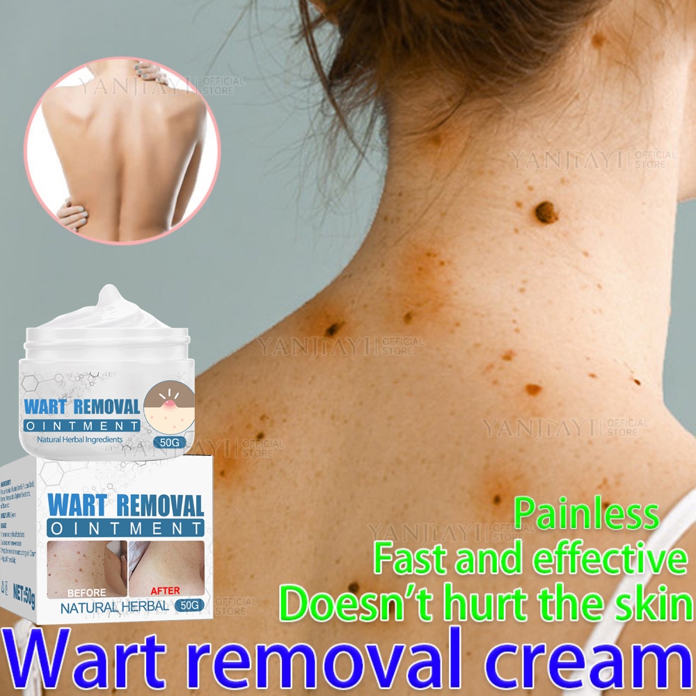 Wart Remover Cream Effective Mole Removal Skin Tags Kulugo Corn Plantar ...