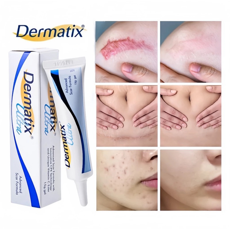 Dermatix Scar Gel for Acne Scars Caesarian Section Scars Injury Scars ...