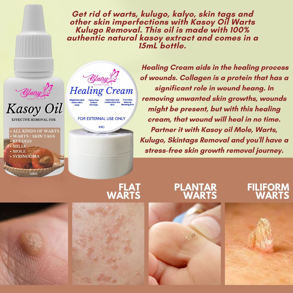 KASOY OIL Kulugo & Warts Remover | Shopee Philippines