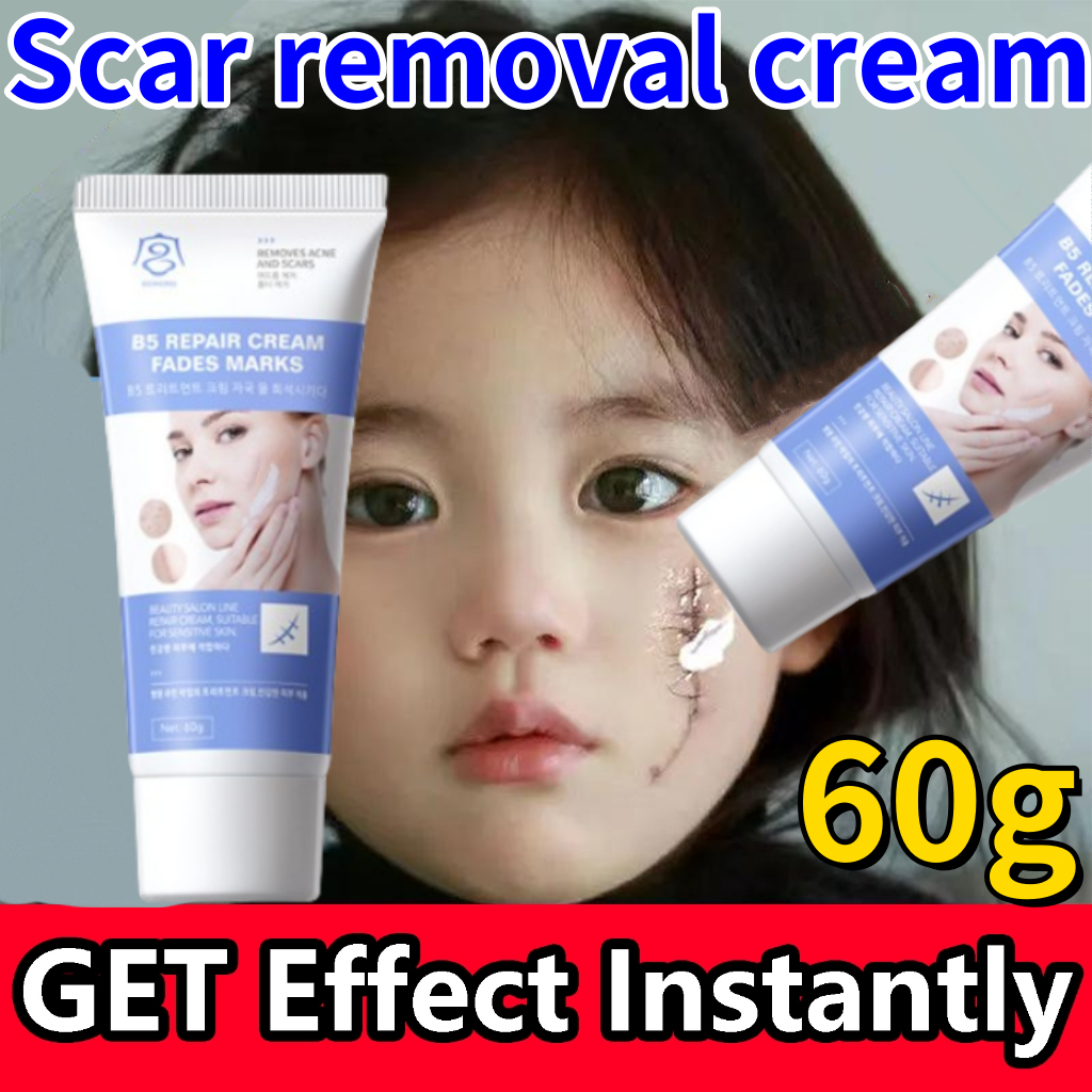 Scar Removal Cream Remover Acne Scar Cream For Old Peklat Scar Stretch ...