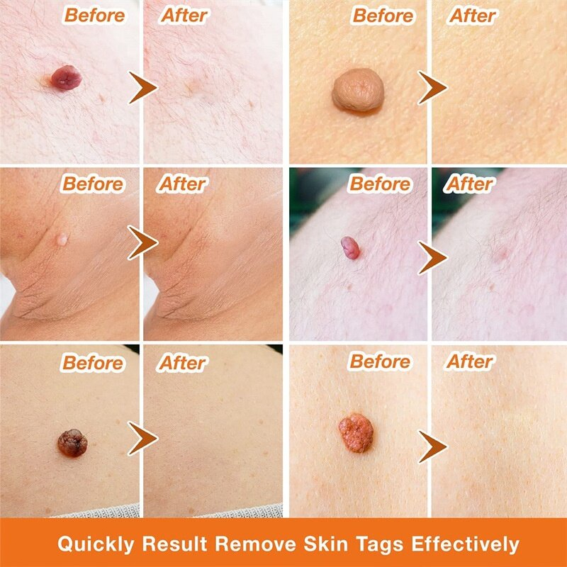 Warts remover original Mole remover Skin tag remover Removal freckle ...