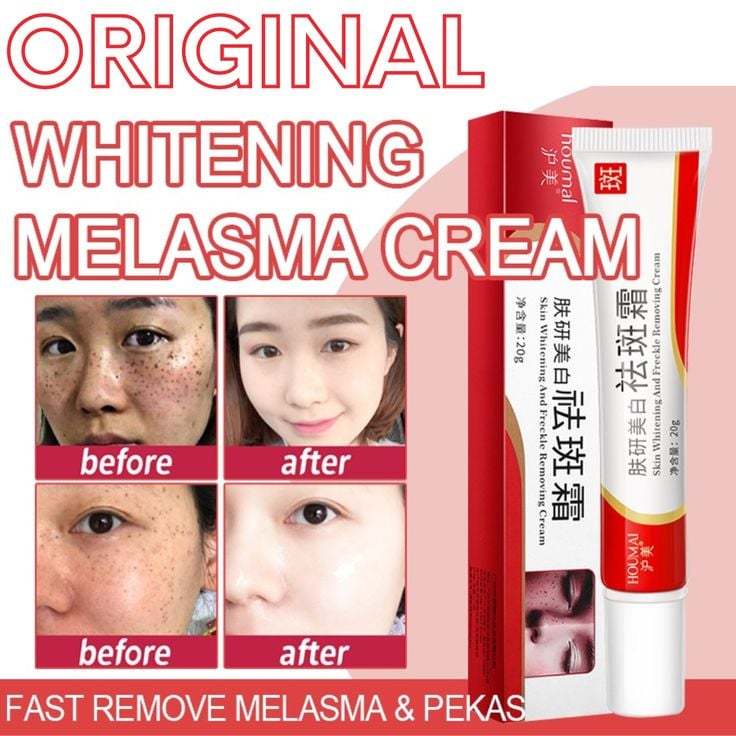 HOUMAI Melasma Cream Effective Remove Freckles Dark Spot Melasma Cream ...