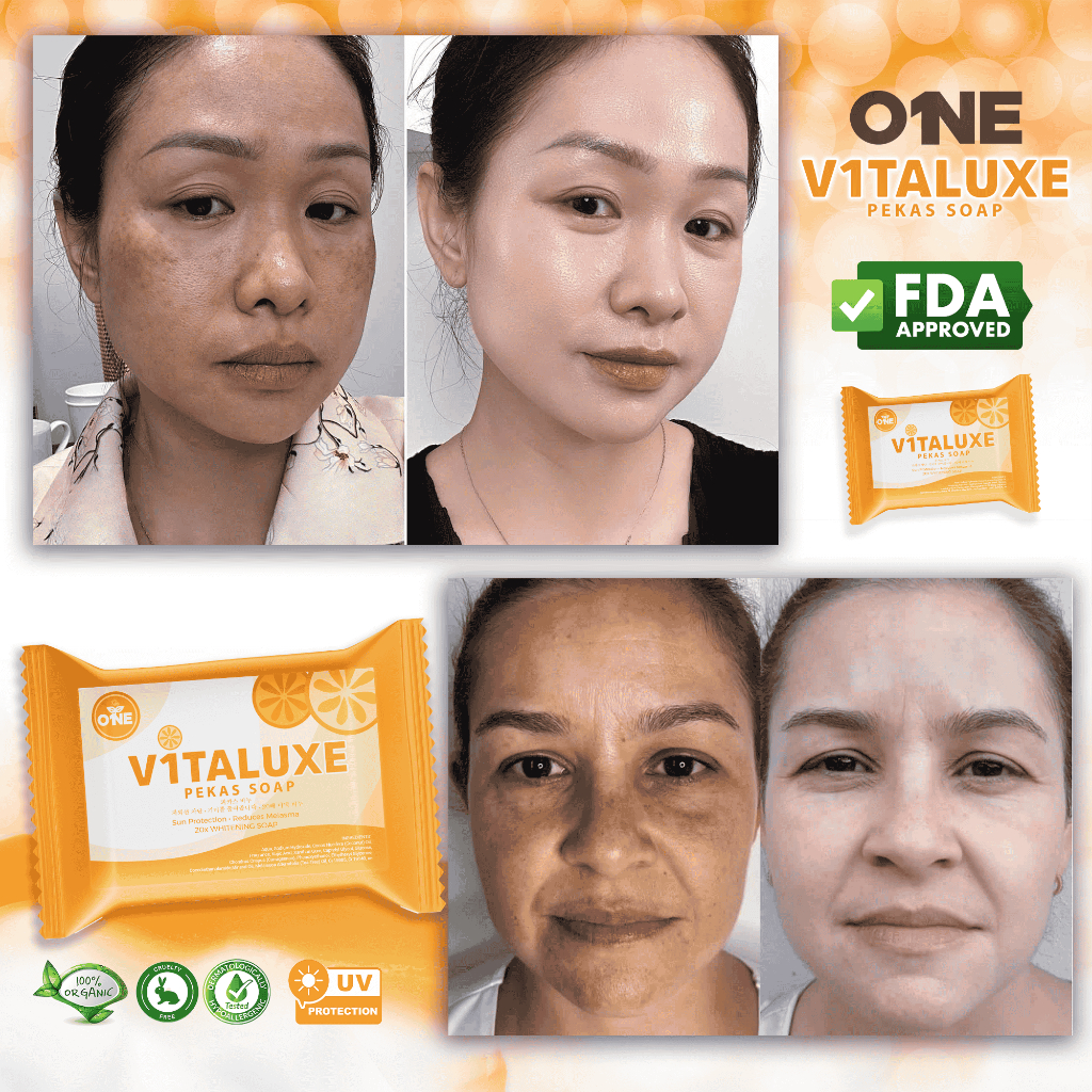 One V1taluxe Pekas Melasma Soap-Dark Spots, Melasma, Pekas ...